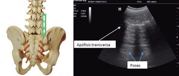 Signo Del Psoas