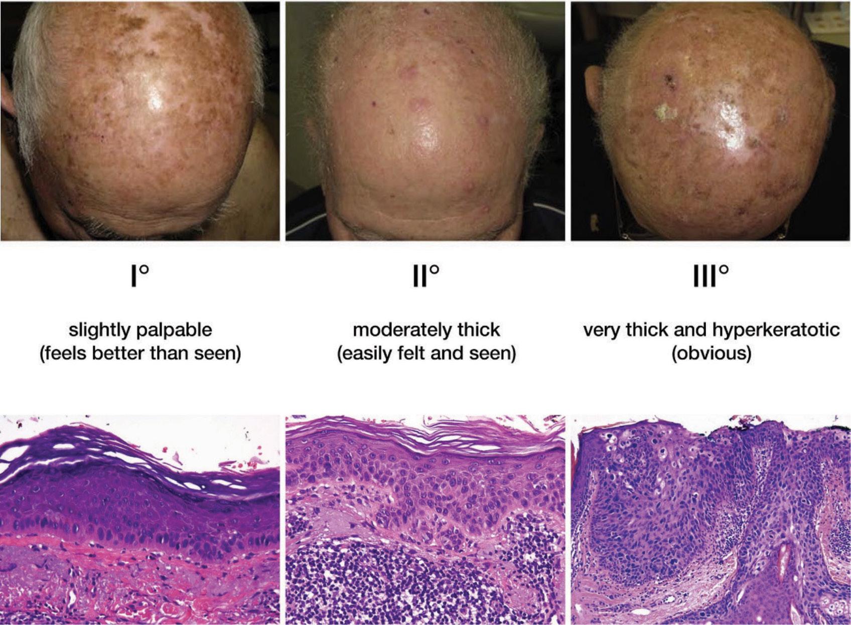 Management in clinical practice of multiple face and scalp AK - Issuu