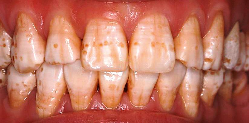 Minimally invasive aesthetic restoration for severe dental fluorosis ...