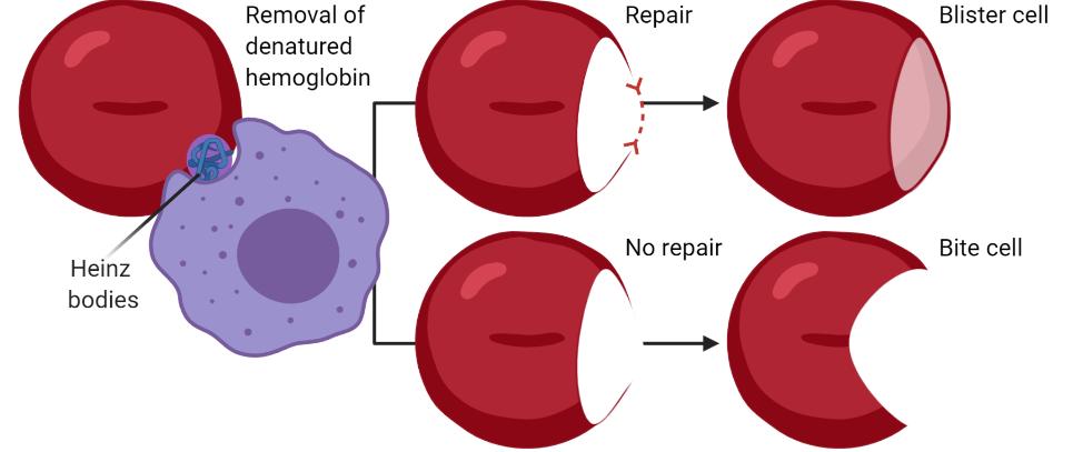 Heinz Bodies And Bite Cells