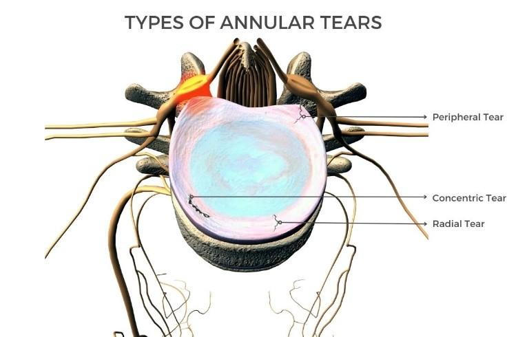 Annulus Fibrosus Tear