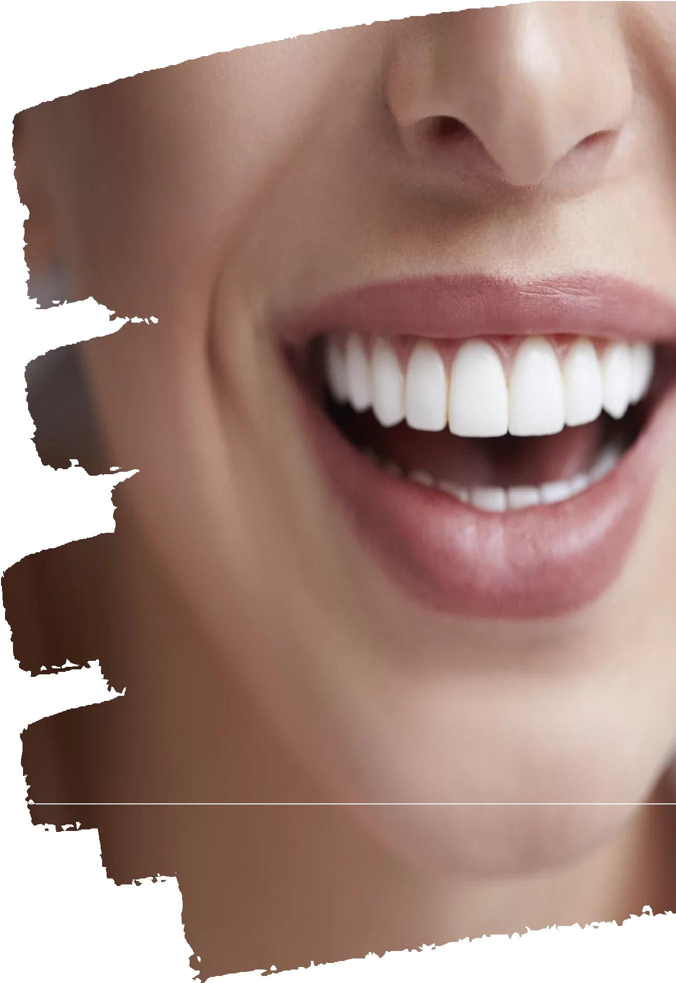 Dental Veneers the perfect solution for gap-less, sparkling teeth by ...
