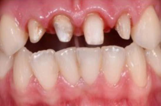 Designing pressing veneering Article by Davor Marković DT, Kreševo by ...