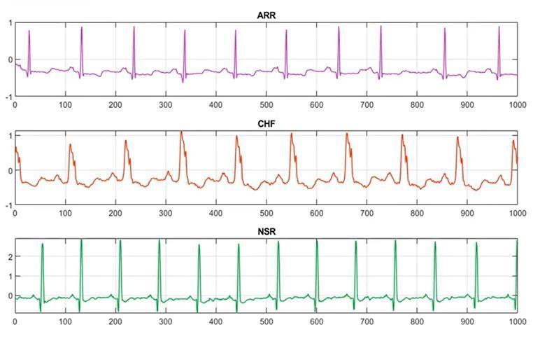 ECG signal analysis using continuous wavelet transformation and deep neural network by IRJET ...