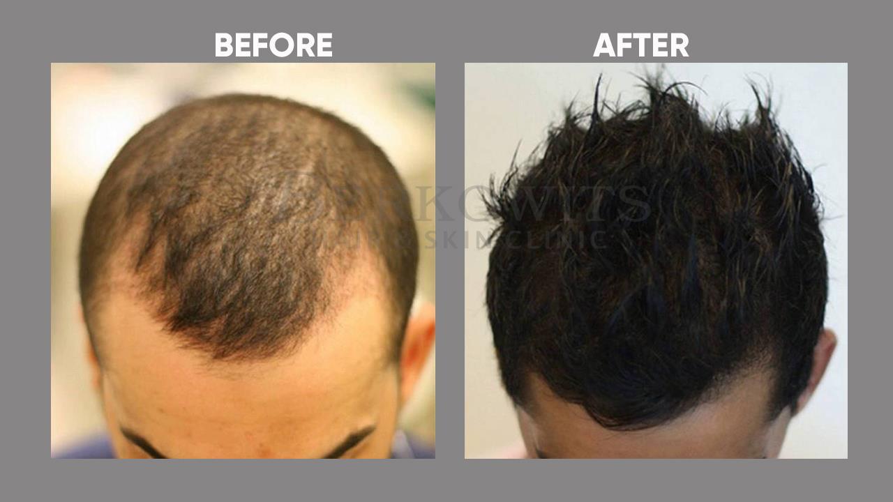 Prp Hair Treatment The Best Solution For Hair Loss In Aundh Pune By Avanti Skin Clinic Issuu