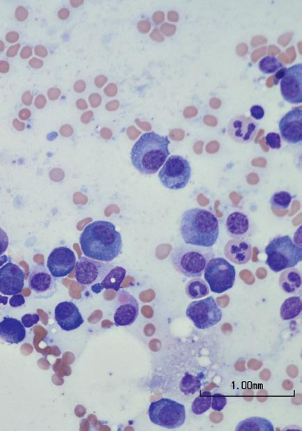 Understanding Your Test Results by International Myeloma Foundation - Issuu