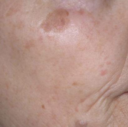 LaserAway Services Lookbook by LaserAway - Issuu