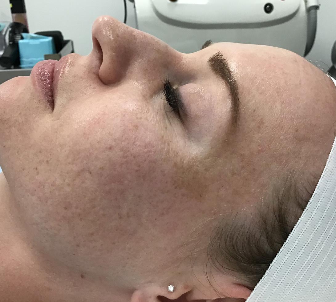 LaserAway Services Lookbook by LaserAway - Issuu