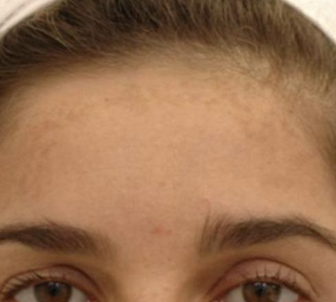 LaserAway Services Lookbook by LaserAway - Issuu