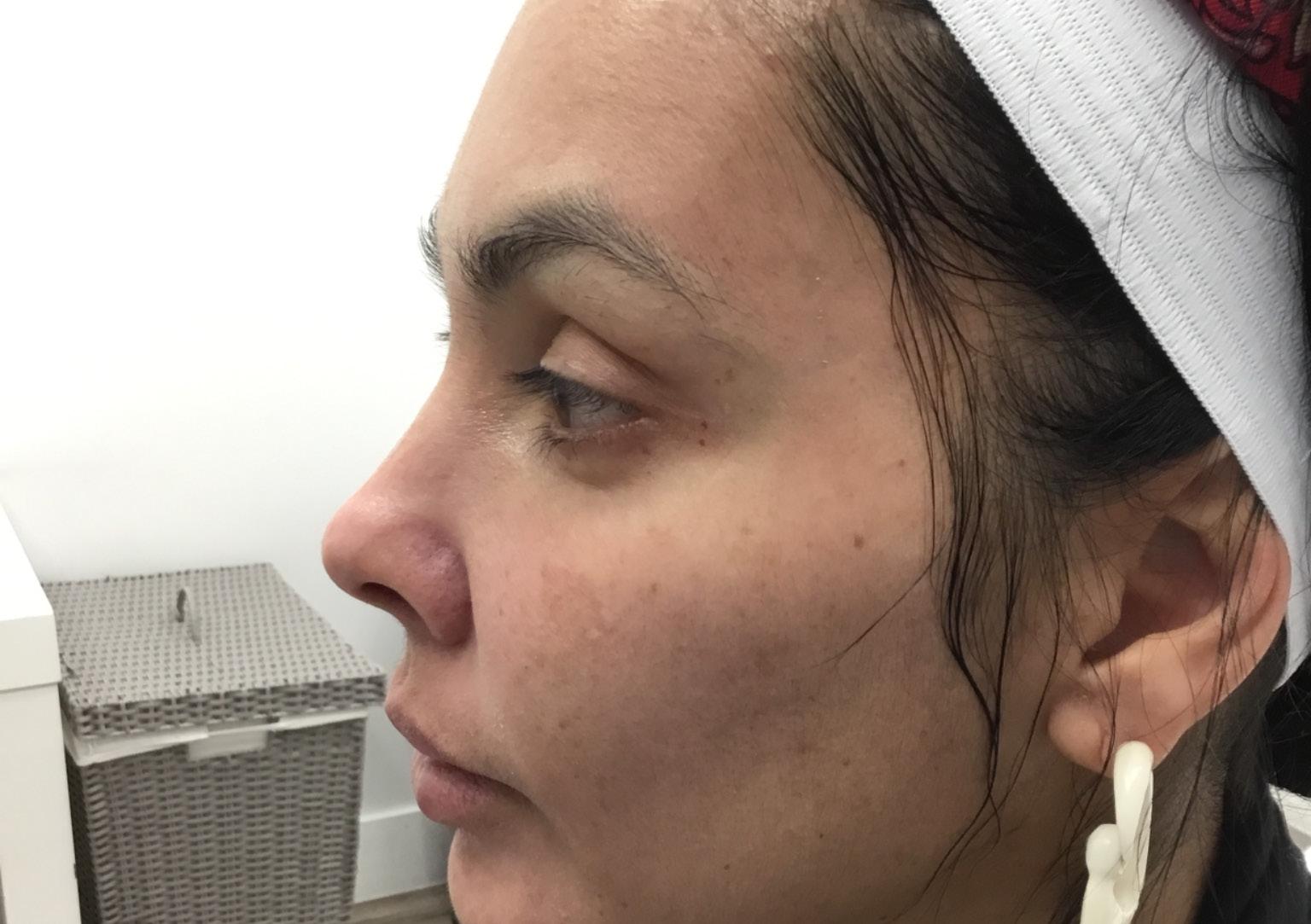 LaserAway Services Lookbook by LaserAway - Issuu