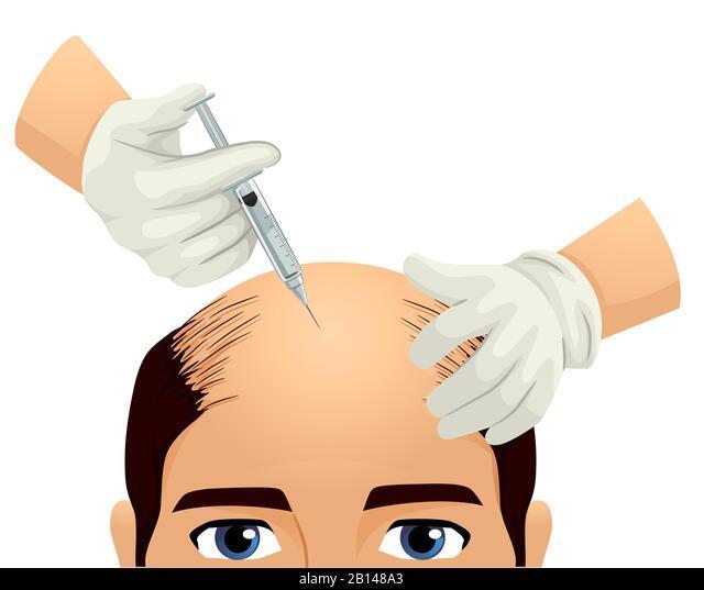 Tips For Post Hair Transplant Care By Avenues Kapadia Issuu