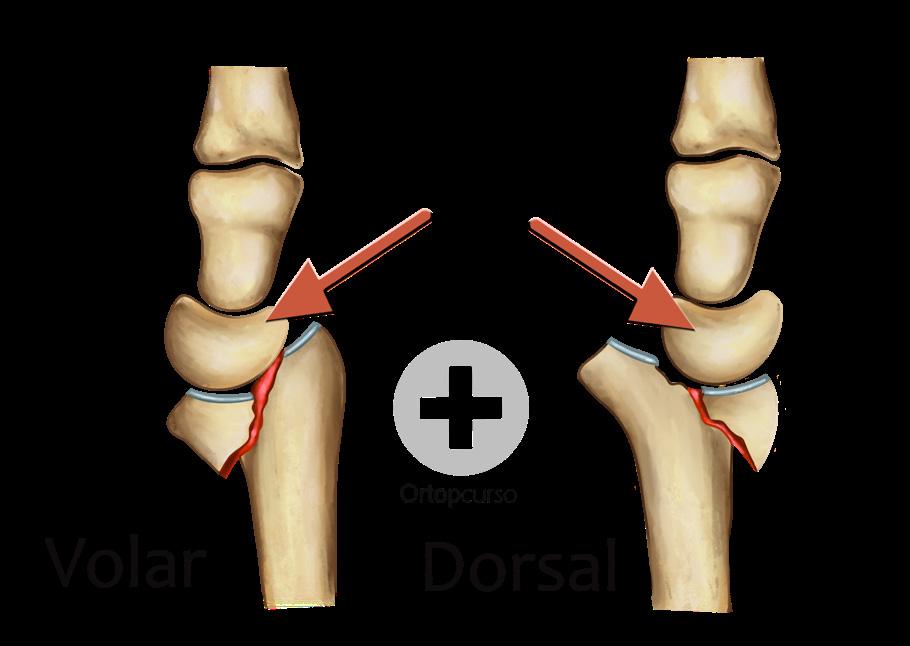 Processo Estilóide Ulnar