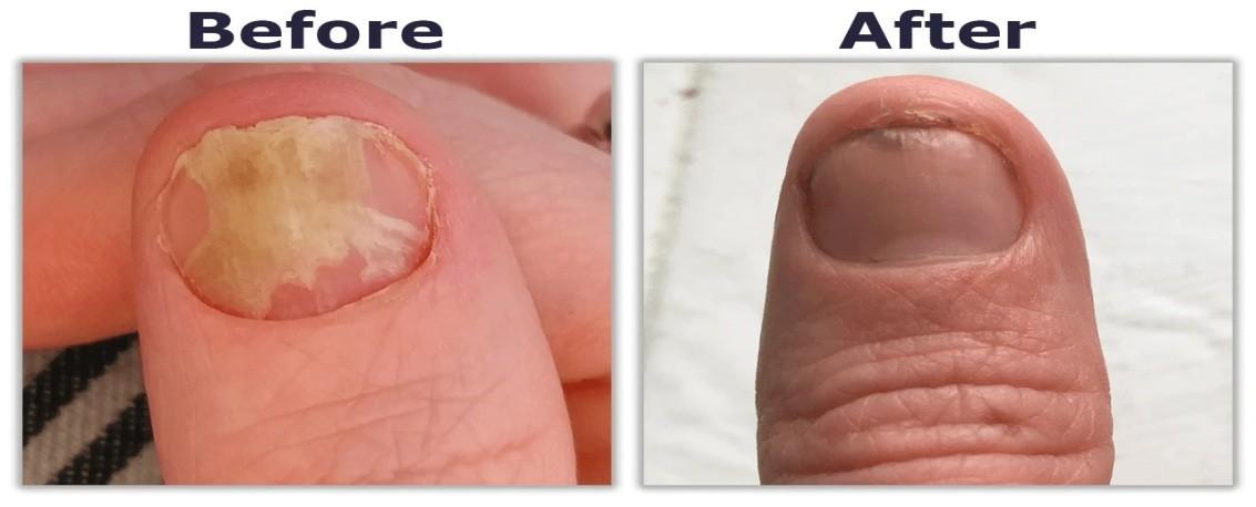 Ingrown Toenail Removal Recovery