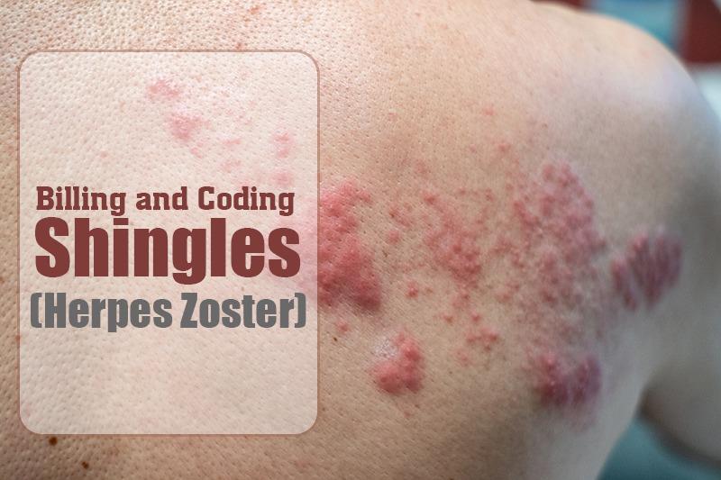 ICD 10 Codes To Report Shingles A Common Skin Condition By Outsource ICD 10 Codes To Report Shingles A Common Skin Condition By Outsource