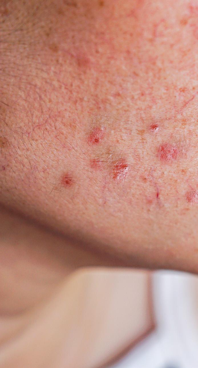 Updates in Dermatology: Skin disorders by NAOS_MedicalRelations - Issuu