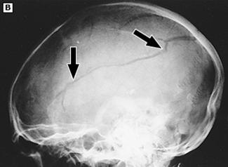 02. FRACTURAS DE CRÁNEO - Issuu