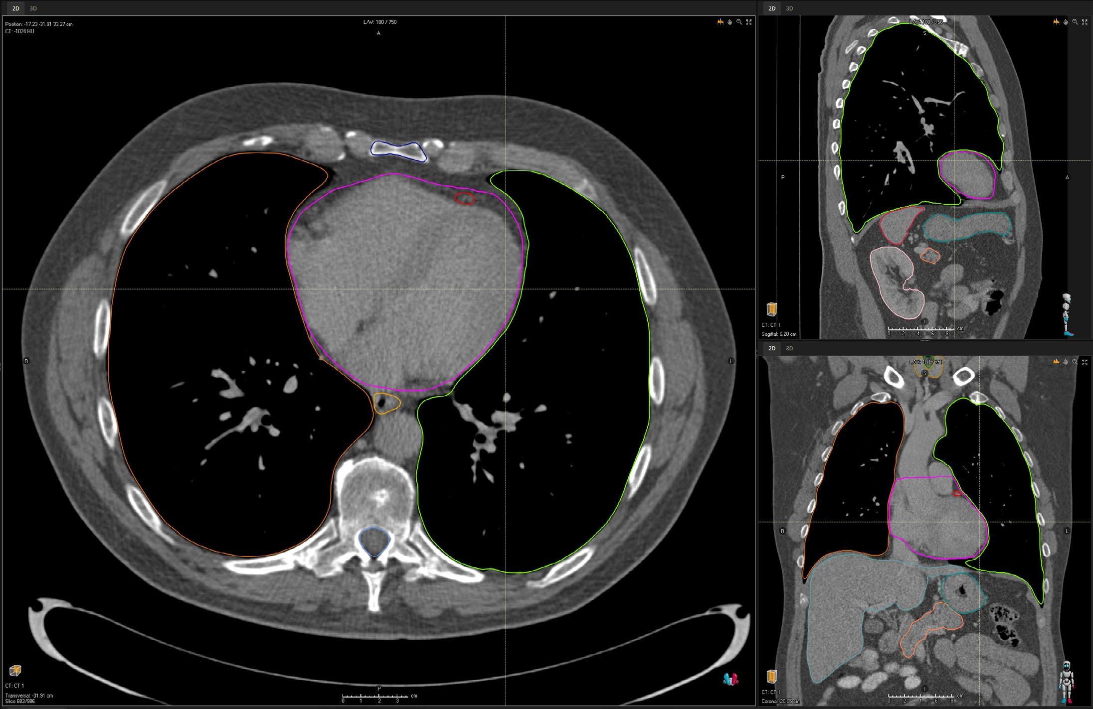 Deep Learning Segmentation model catalogue by RaySearch Laboratories ...