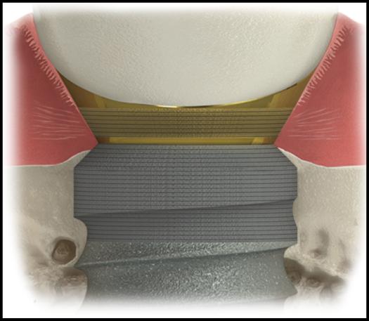 Shortcomings of the BioHorizon Implants by Dr.Niznick - Issuu