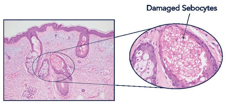 AviClear Product Brochure by Cutera - Issuu