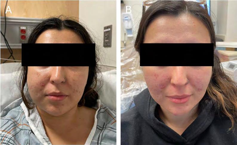 Subcutaneous Facial Emphysema and Pneumomediastinum Following a Class V ...