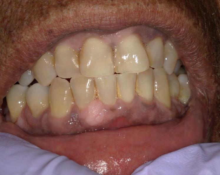 Pebbly Gingival Nodule in an Older Male - Issuu